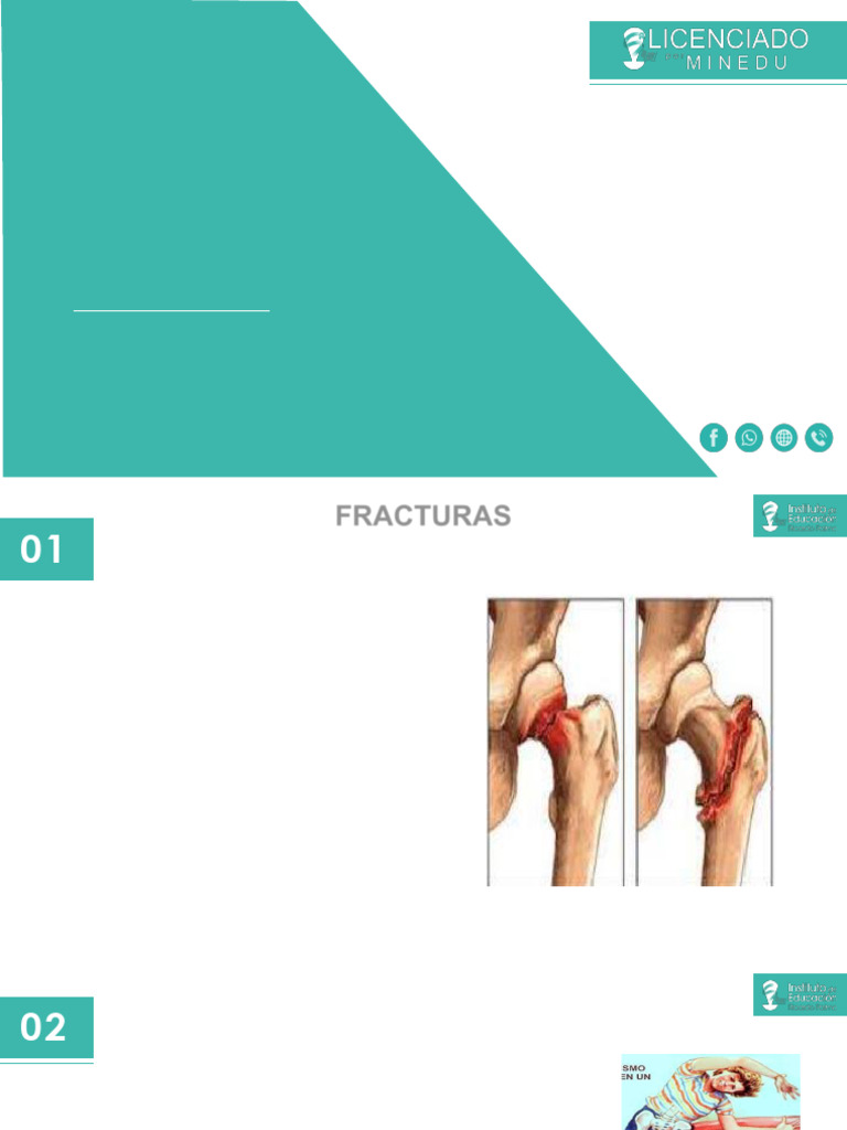 Fractura Oblicua Descompuesta Pdf Hueso Mano