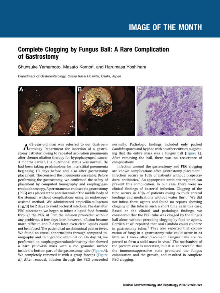 Complete Clogging by Fungus Ball A Rare Complication | PDF | Medicine | Gastroenterology