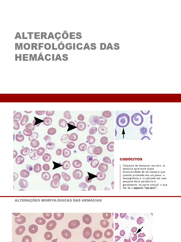 Alterações Morfológicas das Hemácias | PDF | Hemácia | Biologia