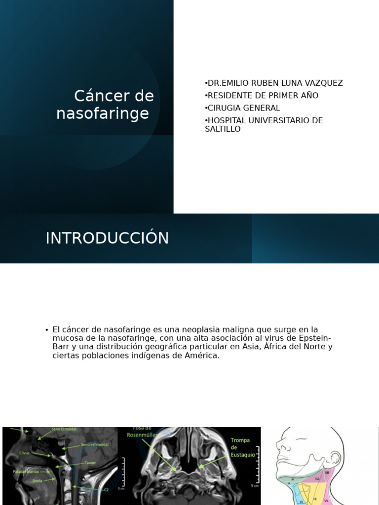 Neoplasia Maligna de Nasofaringe | PDF | Cáncer | Enfermedades y trastornos