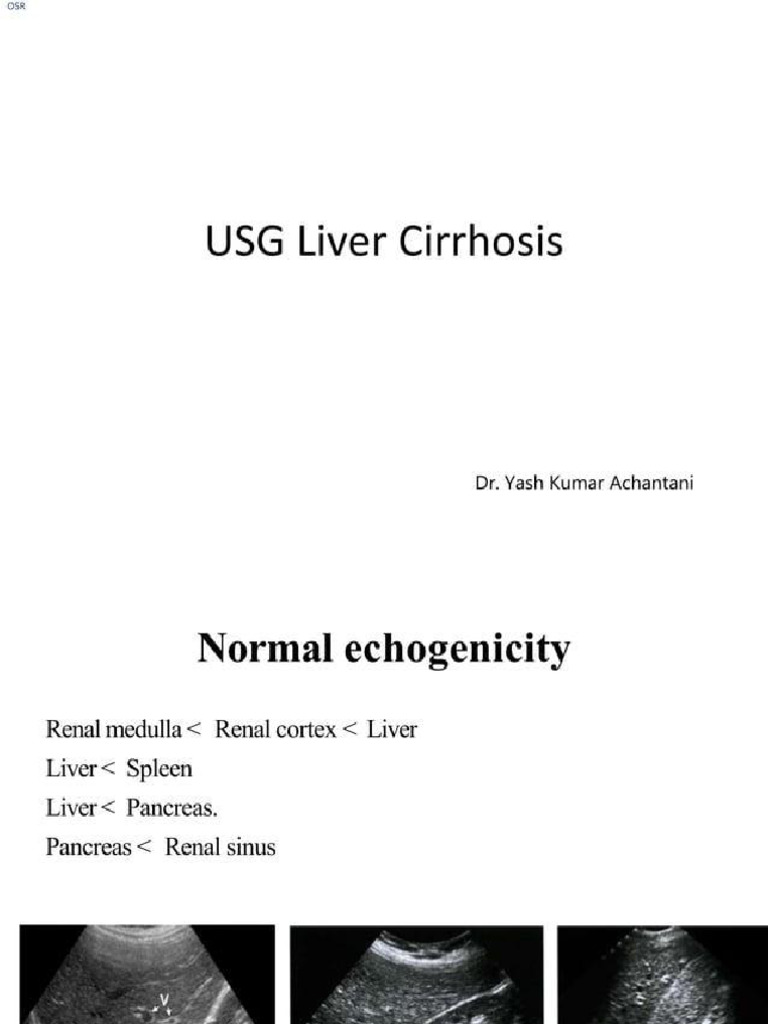 Liver Cirrhosis | PDF