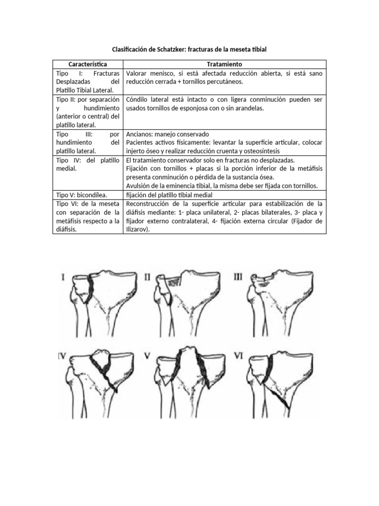 Clasificación de Schatzker en fracturas tibiales | PDF