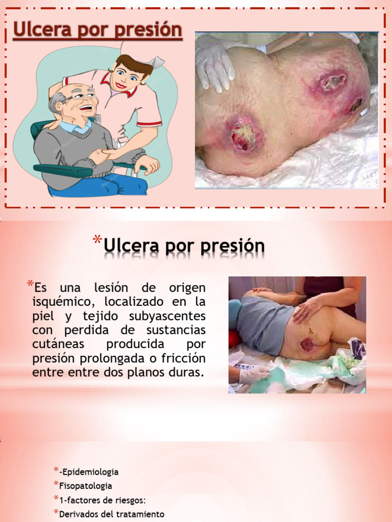 Presentación Ulceras Por Presion 1 Pdf