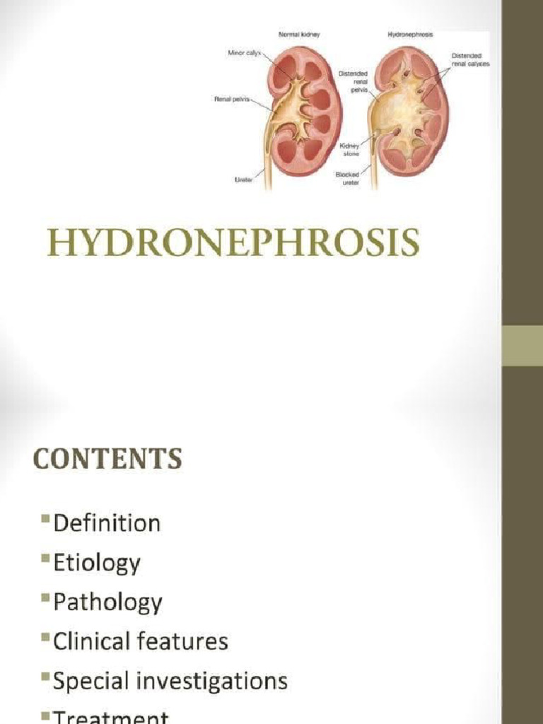 HYDRONEPHROSIS | PDF