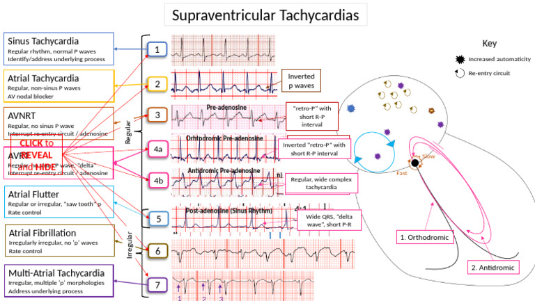SVT Interactive Board For Presenting 1 | PDF | Diseases And Disorders ...