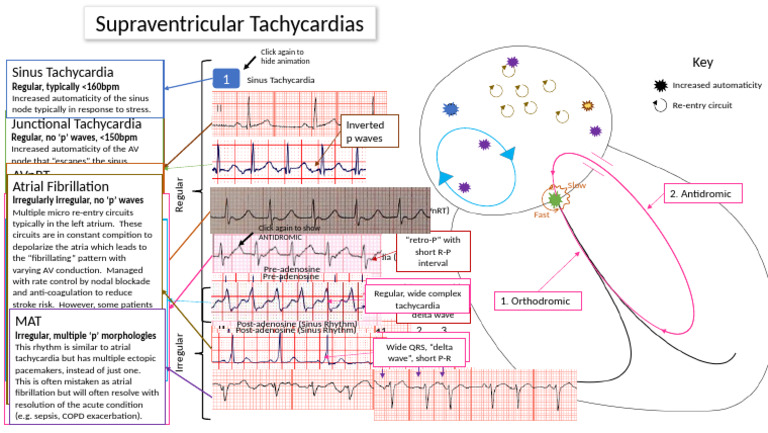 SVT Interactive Board For Learning | PDF | Physiology | Heart