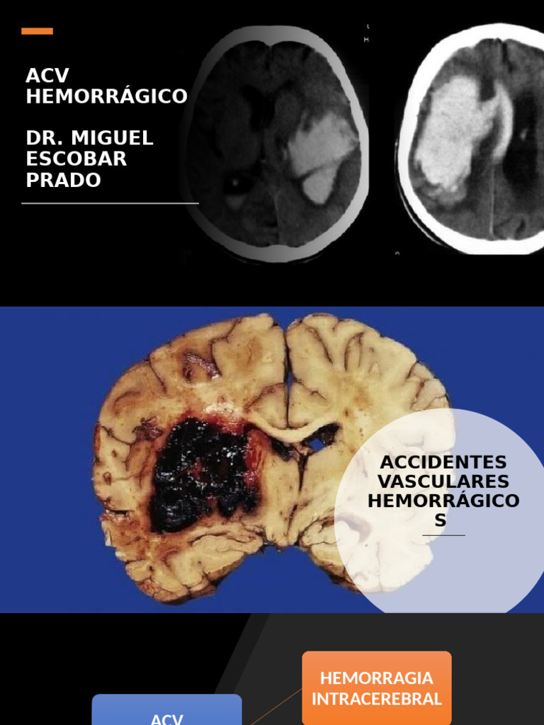 ACV Hemorrágico: Causas y Tratamiento | PDF | Carrera | Hipertensión