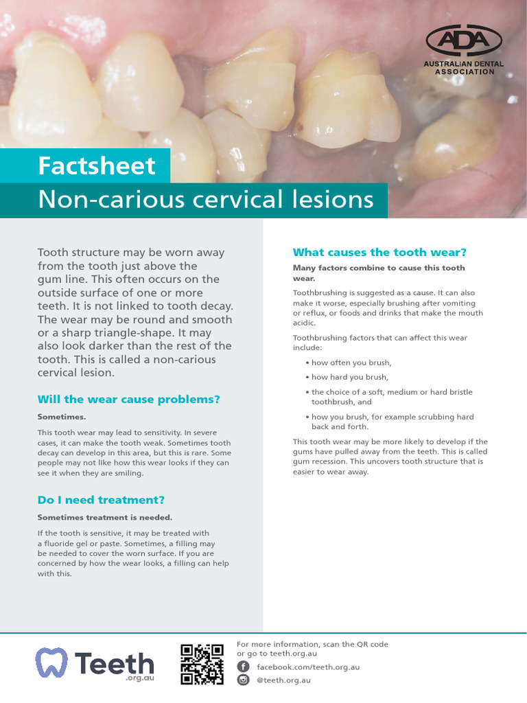 Classification of Non-Carious Cervical Lesions | PDF | Dentistry ...