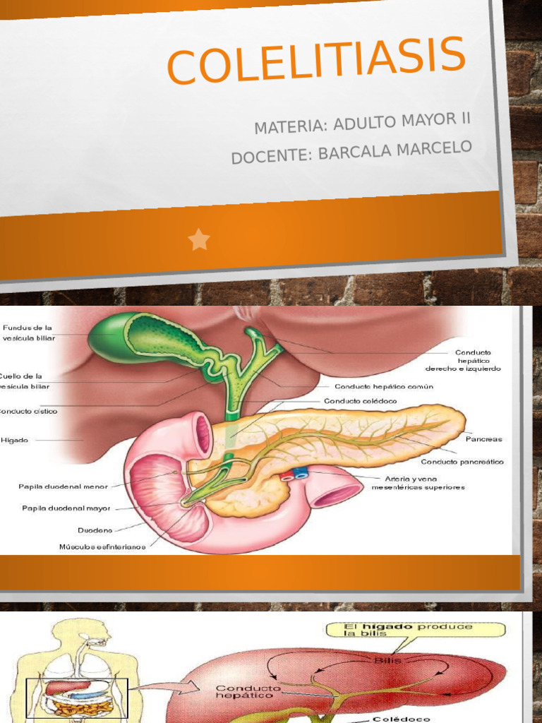 COLELITIASIS | PDF