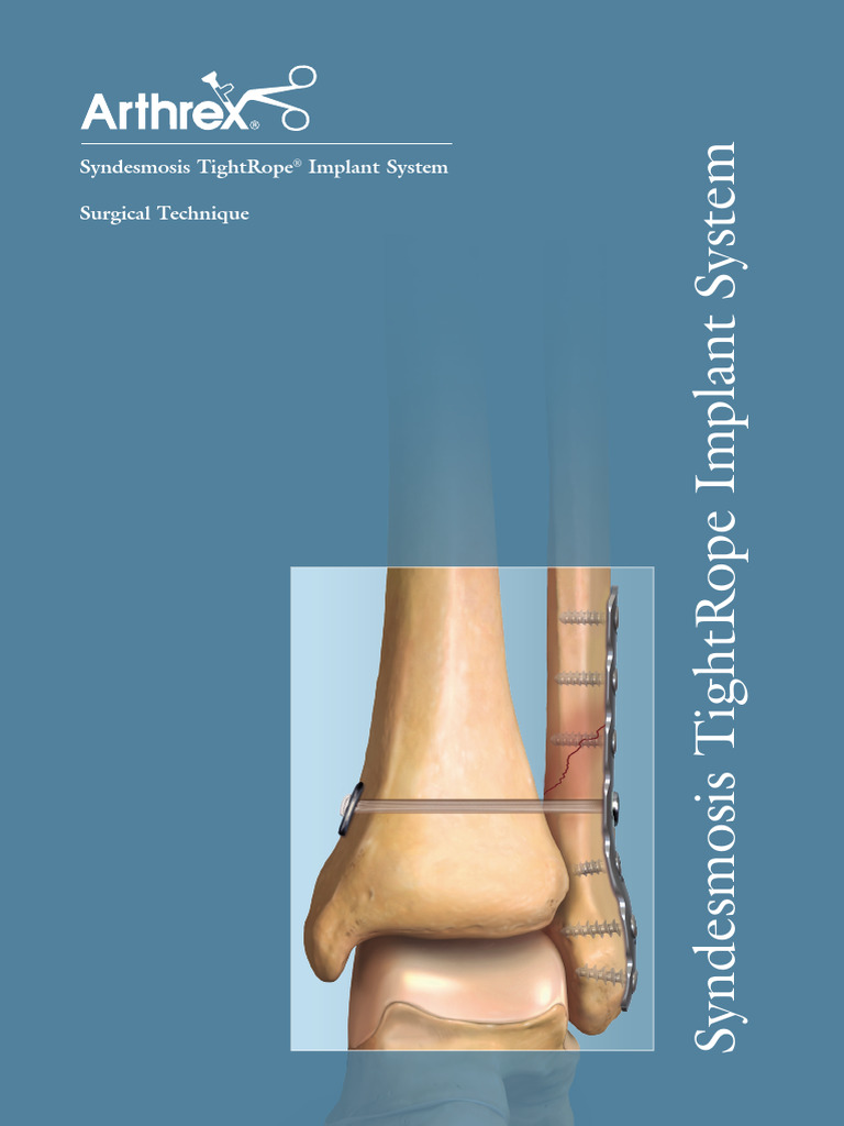 Syndesmosis Tightrope Implant System | PDF | Ankle | Musculoskeletal System