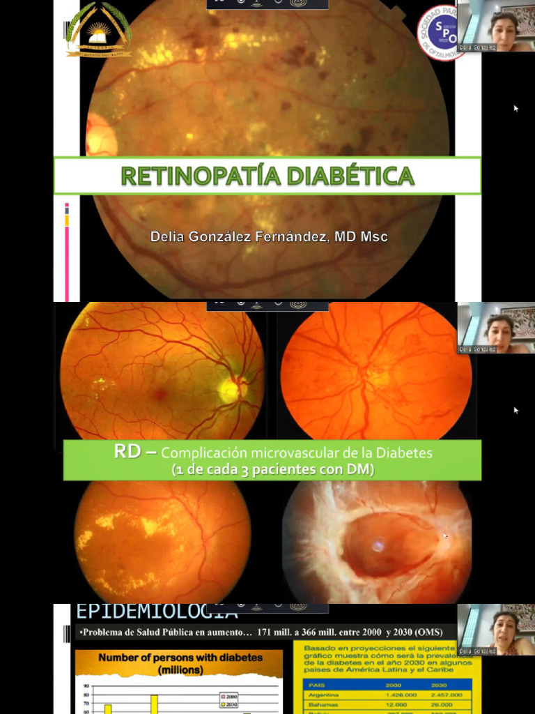 Retinopatía Diabética | PDF