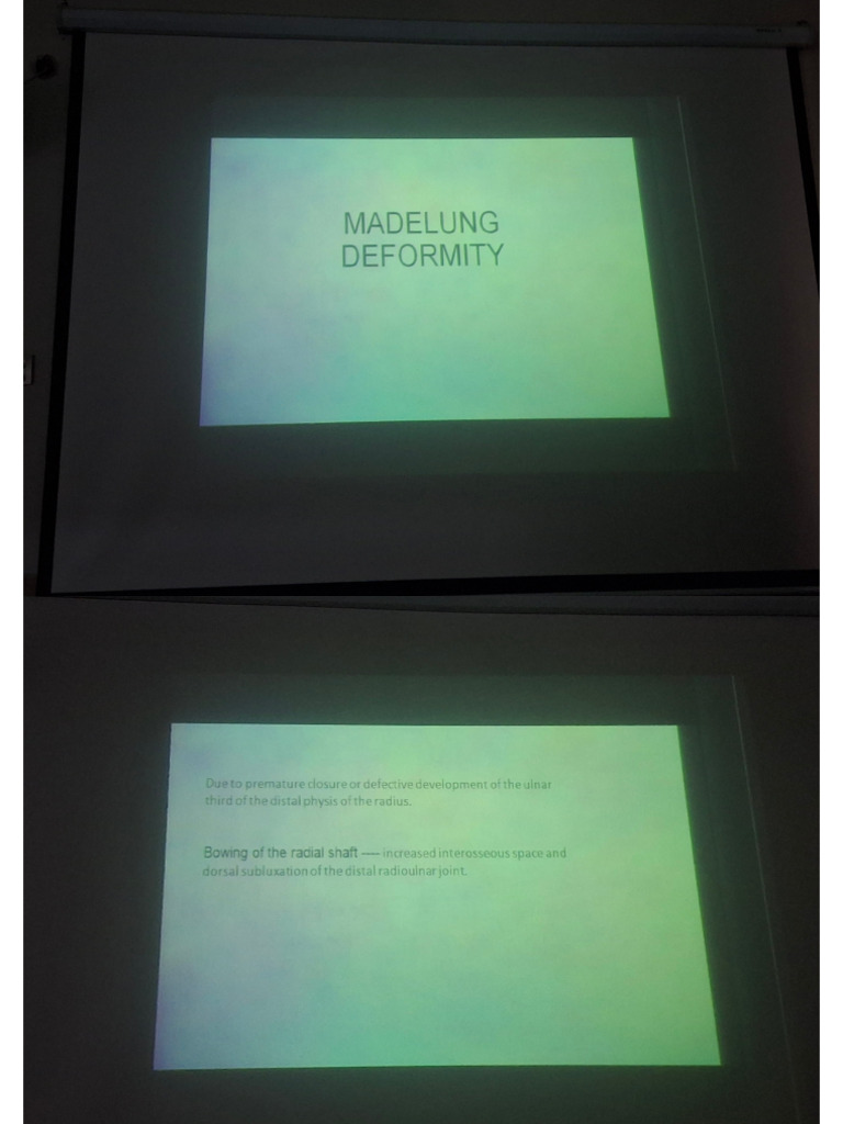 Madelung Deformity | PDF