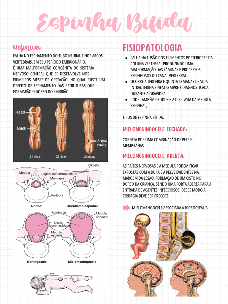 Espinha Bifida | PDF | Coluna vertebral | Sistema nervoso