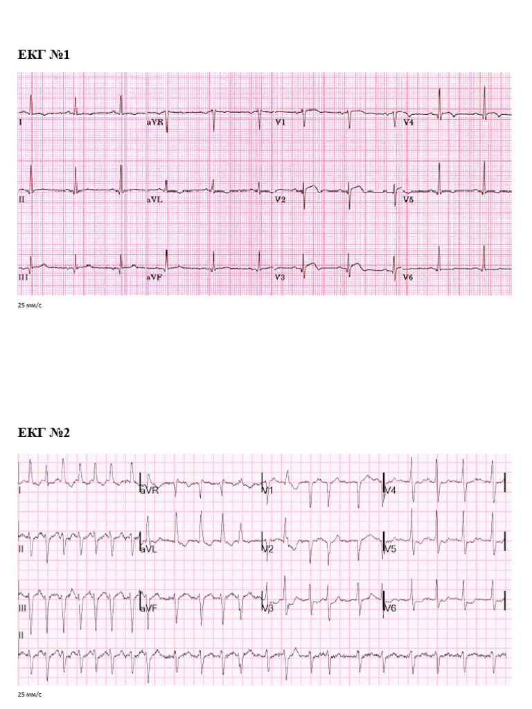 httpmisa.meduniv.lviv.uapluginfile.php259692mod resourcecontent1Приклади20ЕКГ20на20екзамен PDF | PDF
