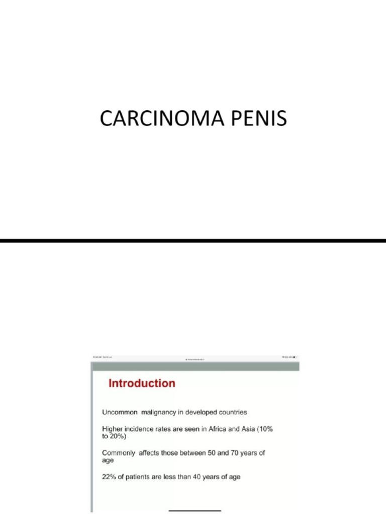 Carcinoma Penis | PDF