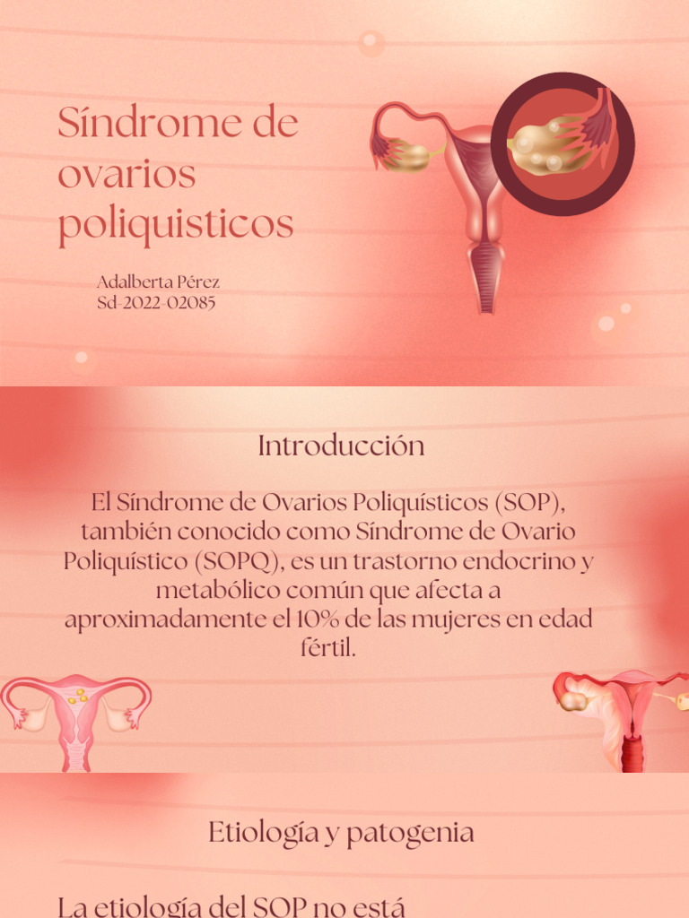 Síndrome de Ovarios Poliquísticos: Causas y Tratamiento | PDF