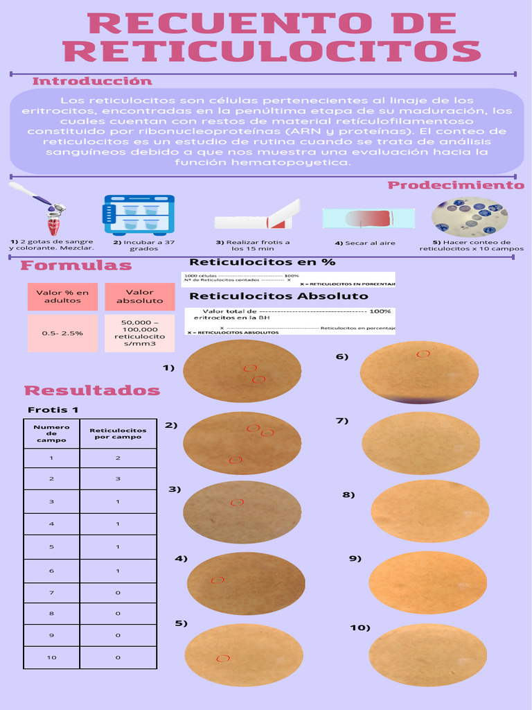 Inforgrafía #7 Conteo de Reticulocitos | PDF | Medicina CLINICA | Biología Celular