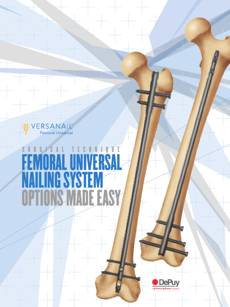Versanail - Universal Nailing System - Depuy - ST | PDF | Implant (Medicine) | Screw