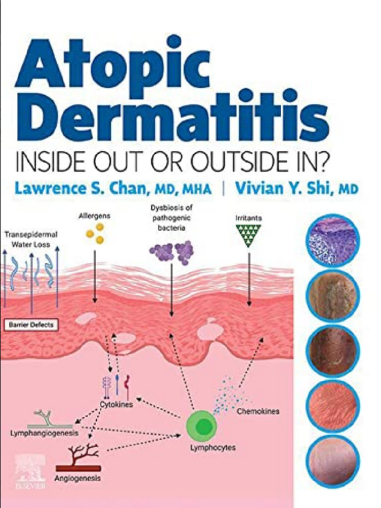Atopic Dermatitis Inside Out or Outside In | PDF | Dermatitis | Allergy