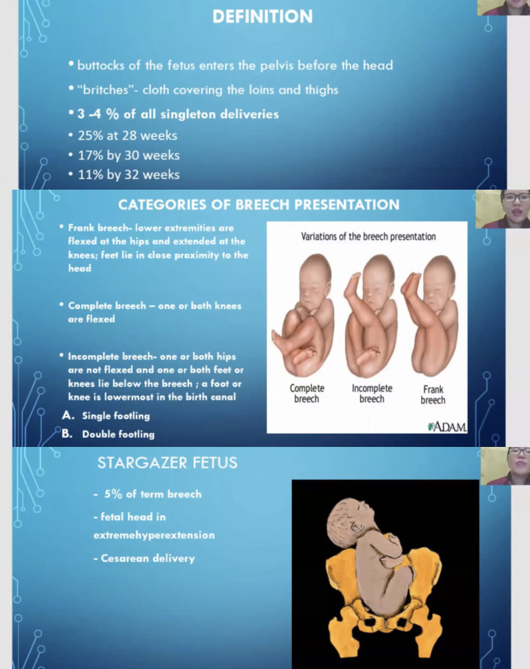 Breech Presentation | PDF
