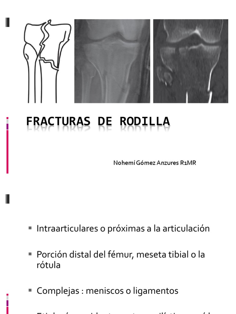 Clasificación y tratamiento de fracturas de rodilla | PDF | Rodilla ...