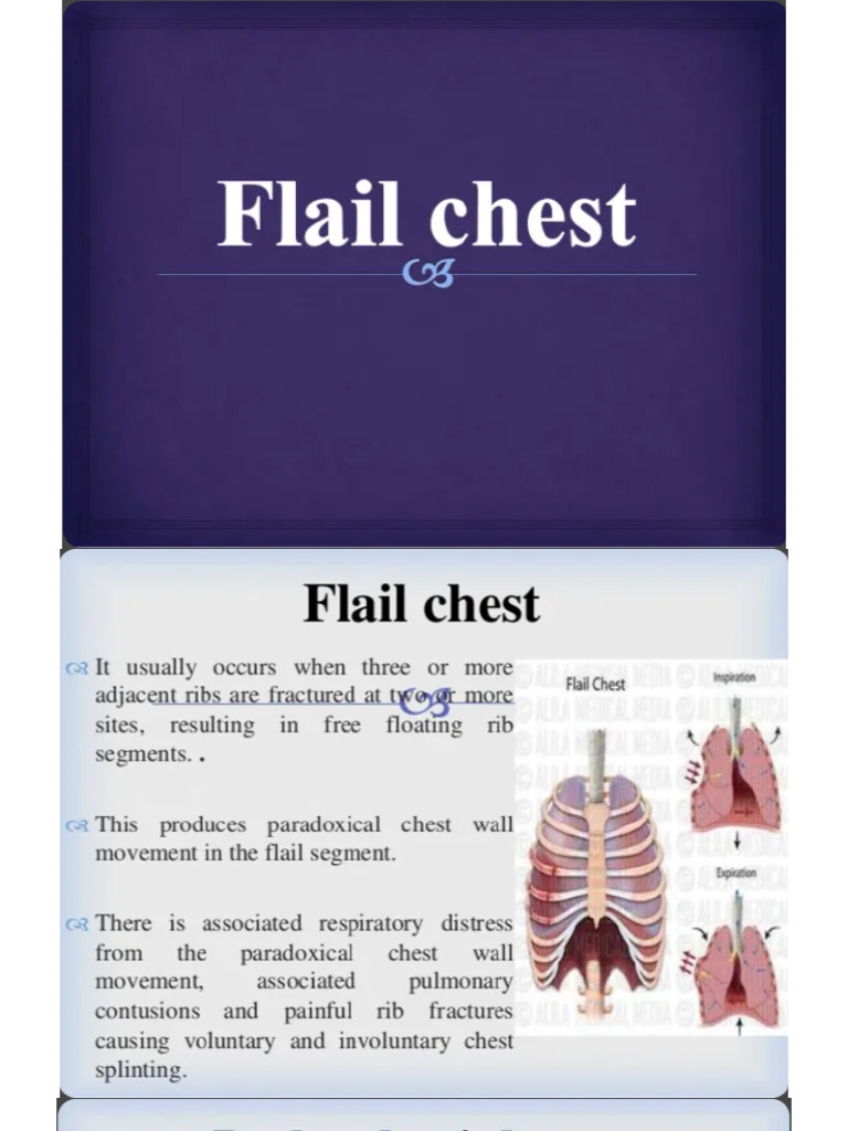Flail Chest | PDF