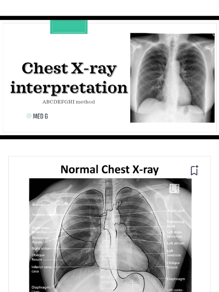 ABCDEFGH Approach For Chest X-Ray | PDF