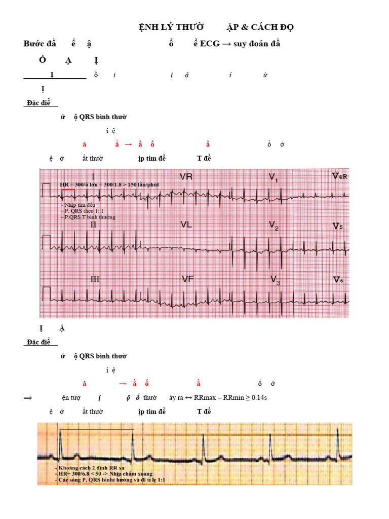 ECG CÁC BỆNH LÝ THƯỜNG GẶP | PDF