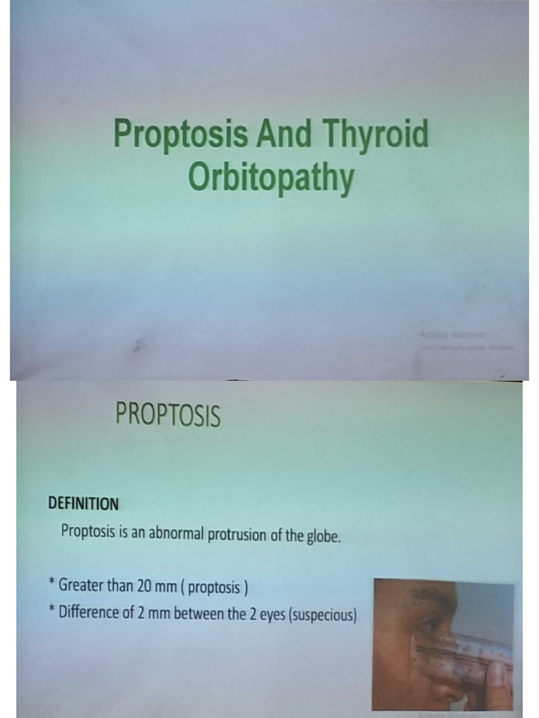 Proptosis and Thyroid Orbitopathy | PDF