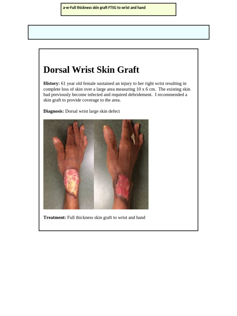 Full Thickness Skin Graft for Wrist Repair | PDF