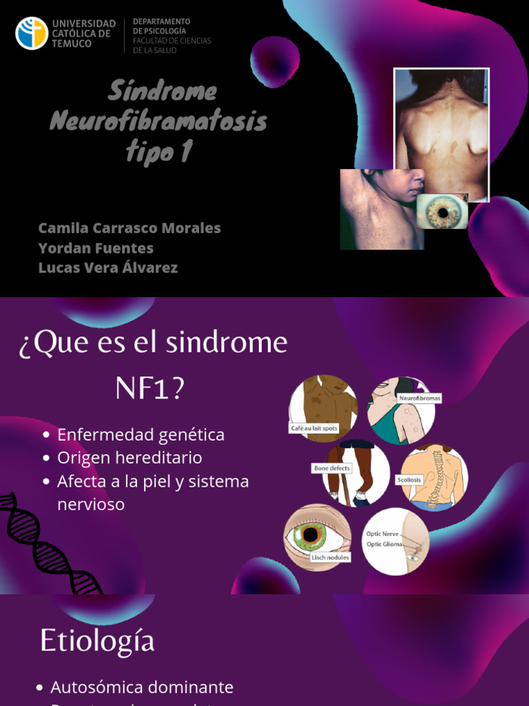 Presentación Síndrome de Neurofibromatosis Tipo 1 (NF1) | PDF | Especialidades Medicas ...