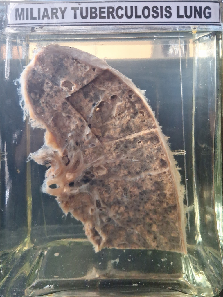 Patho Exam Specimens 1 | PDF | Adenocarcinoma | Neoplasms