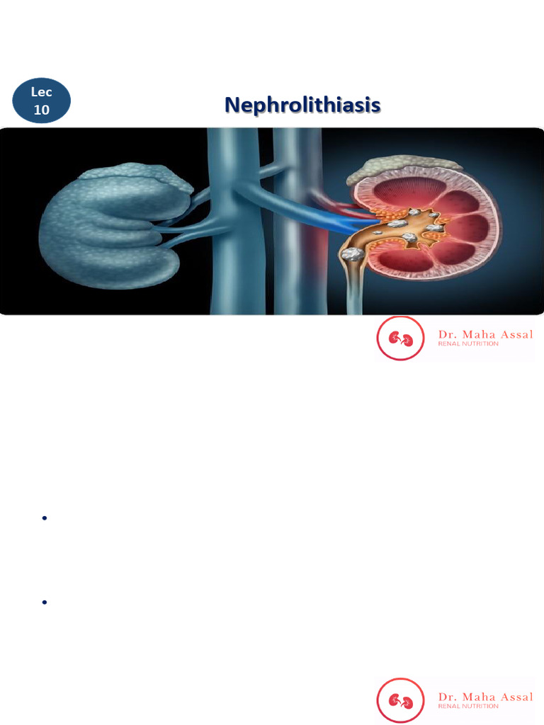 Understanding Nephrolithiasis: Causes & Management | PDF | Medical ...