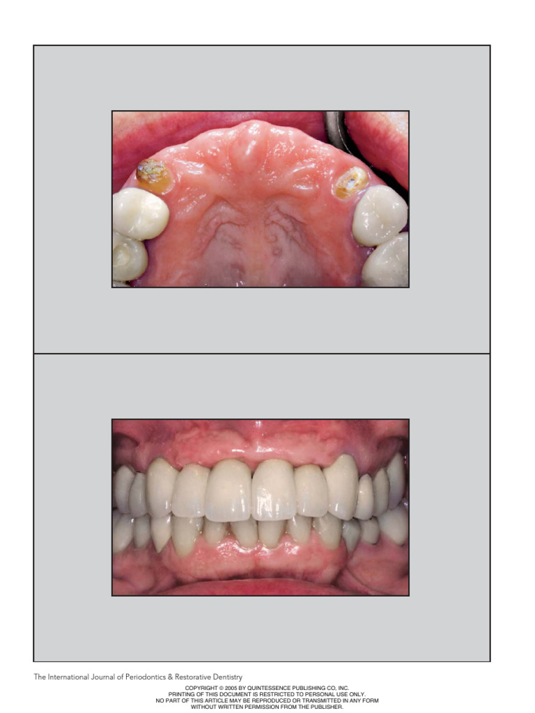 Immediate Implant Placement and Restoration in The Anterior Maxilla 12 ...