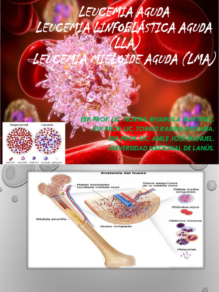 Leucemia 2020 | PDF | Leucemia | Sangre