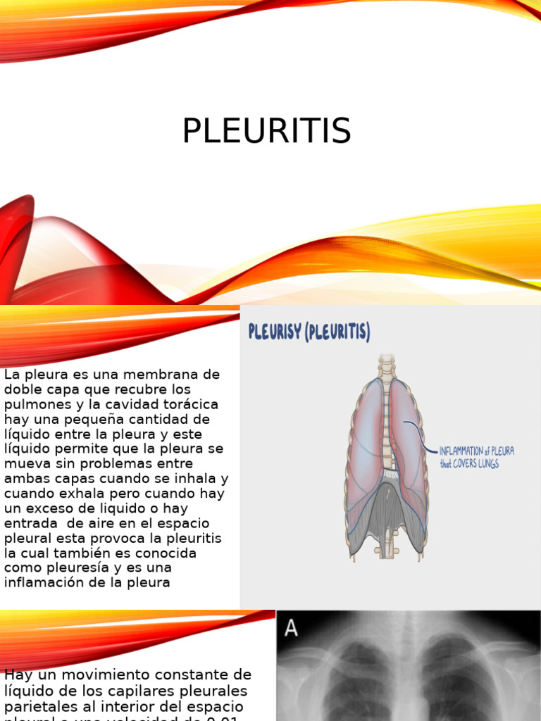 PLEURITIS | PDF