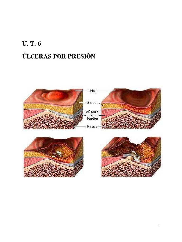 U.T. 4. Úlceras Por Presión | PDF | Herida | Nutrición