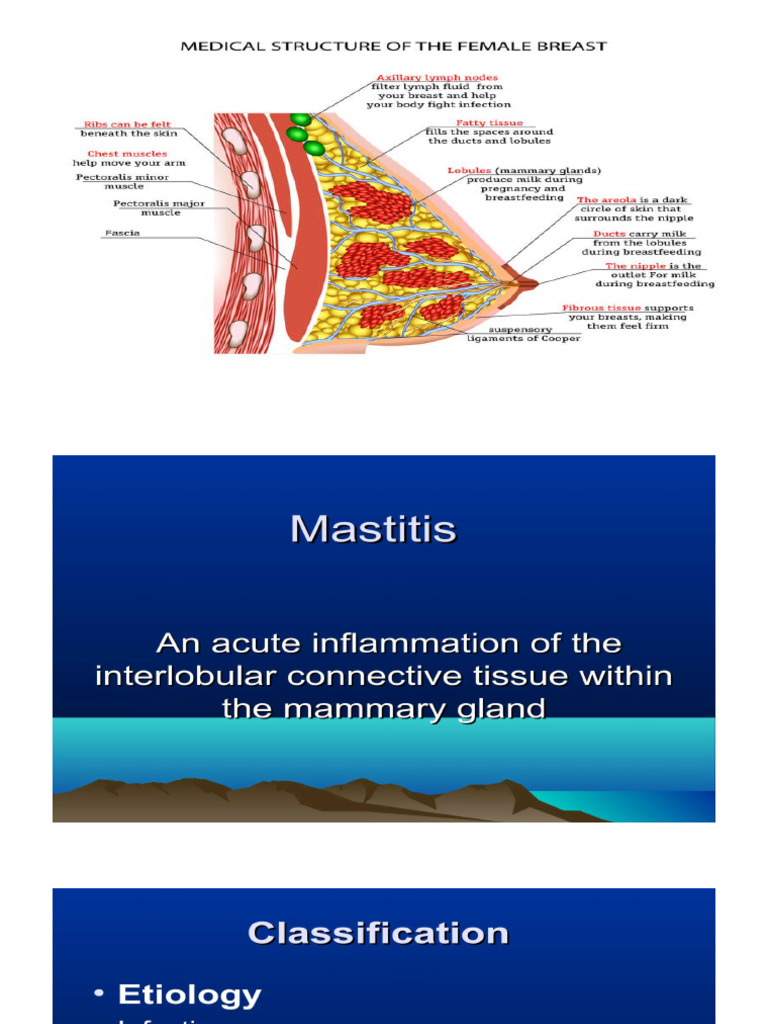 Mastitis | PDF