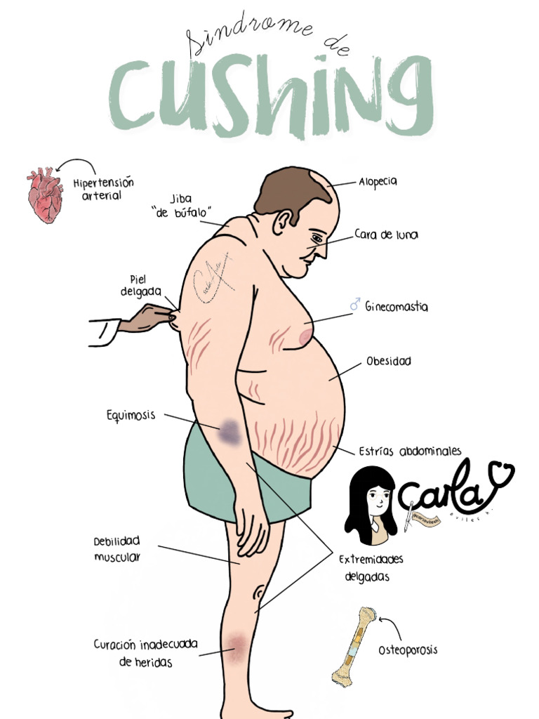 Sindrome de Cushing | PDF