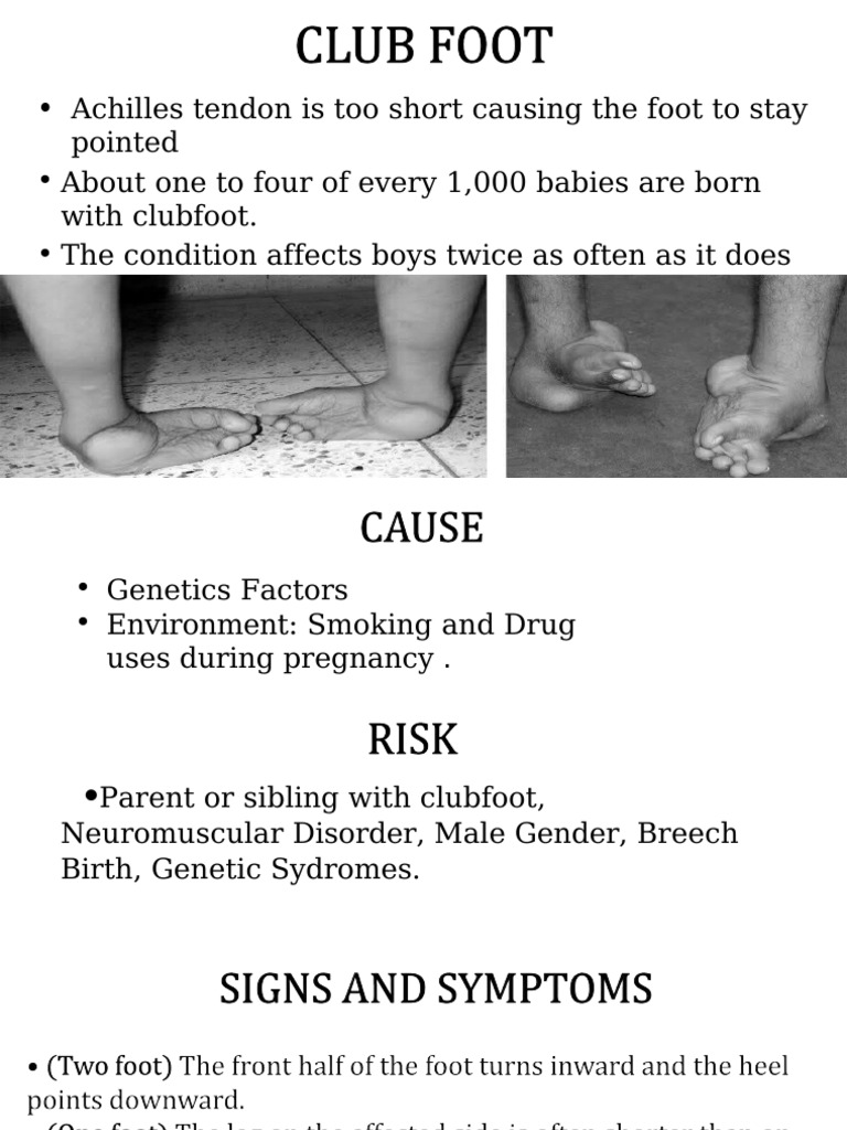 Clubfoot | PDF