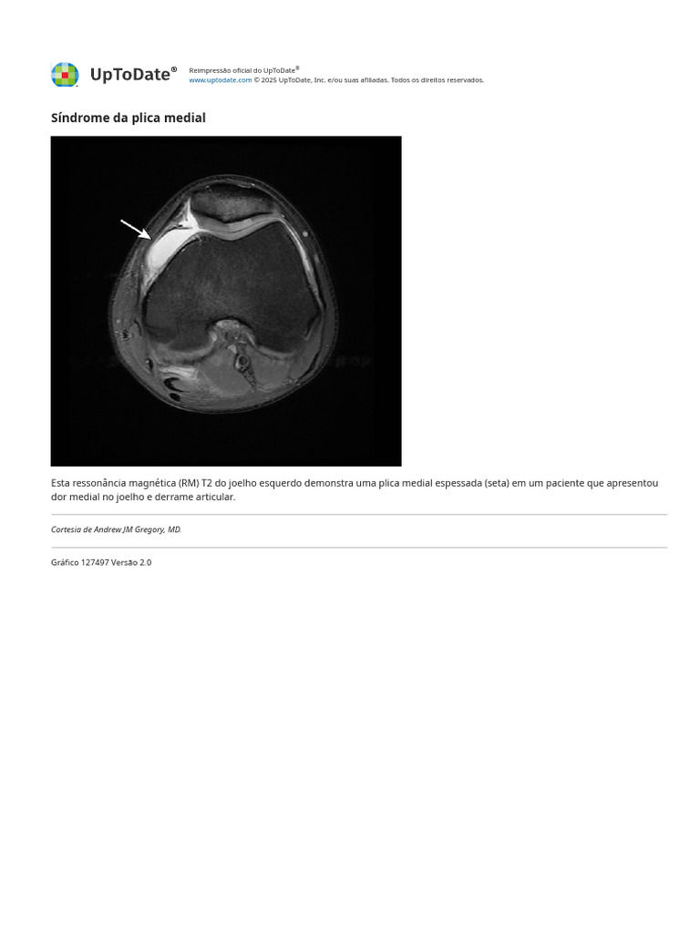 Medial plica syndrome - UpToDate | PDF