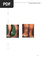 Classificação CEAP em Insuficiência Venosa | PDF | Varizes | Veia