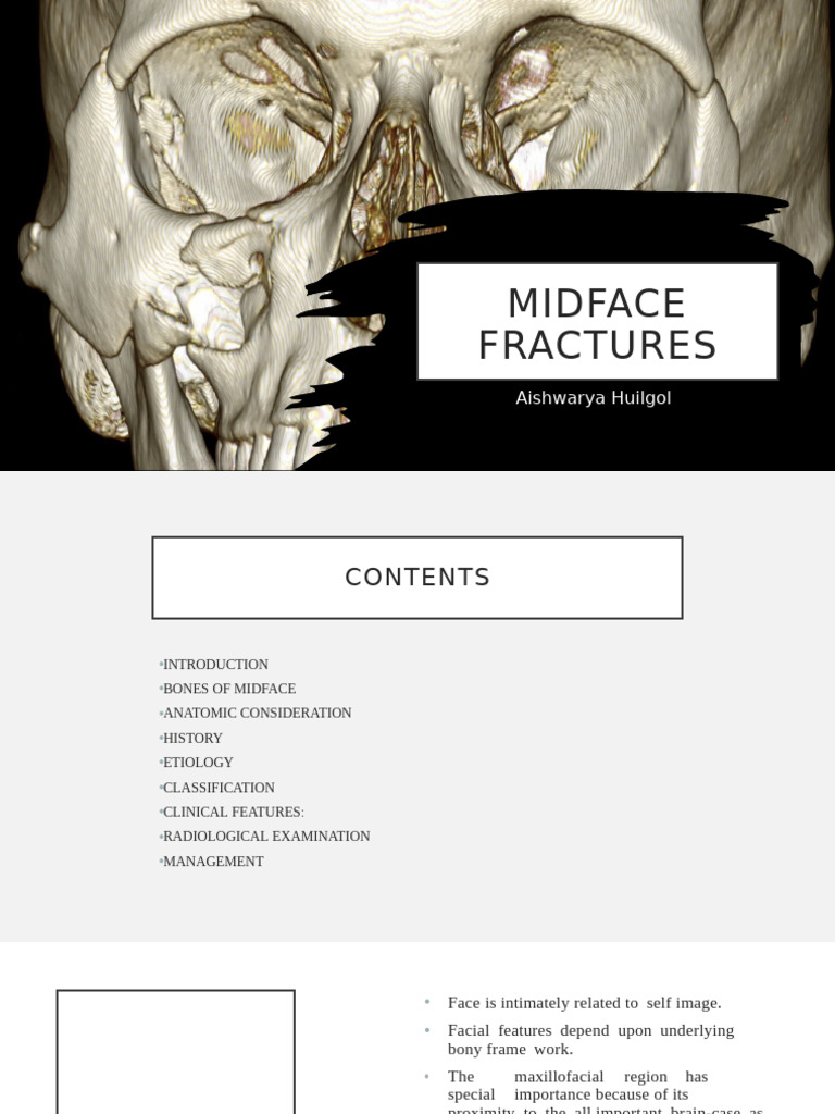 Midface fractures final _ Seminar (1) - Copy | PDF | Skull | Human Nose