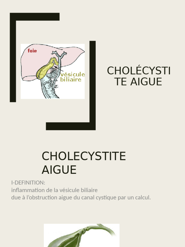 Cholécystite Aiguë : Diagnostic et Traitement | PDF | Vésicule biliaire | Glande exocrine