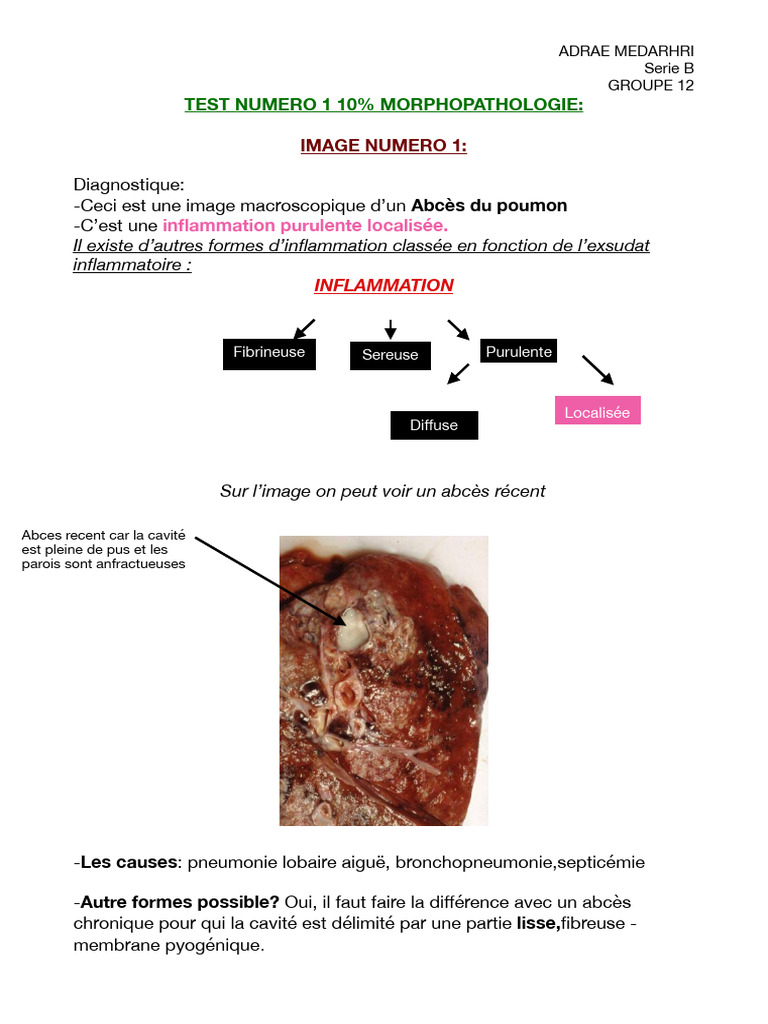 Abcès pulmonaire : diagnostic et causes | PDF | Poumon | Pneumonie