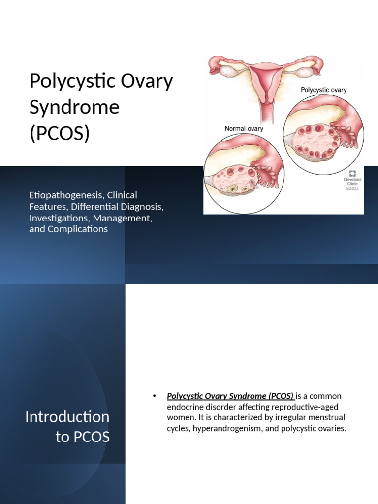 PCOS Presentation Copy | PDF | Polycystic Ovary Syndrome | Reproductive ...