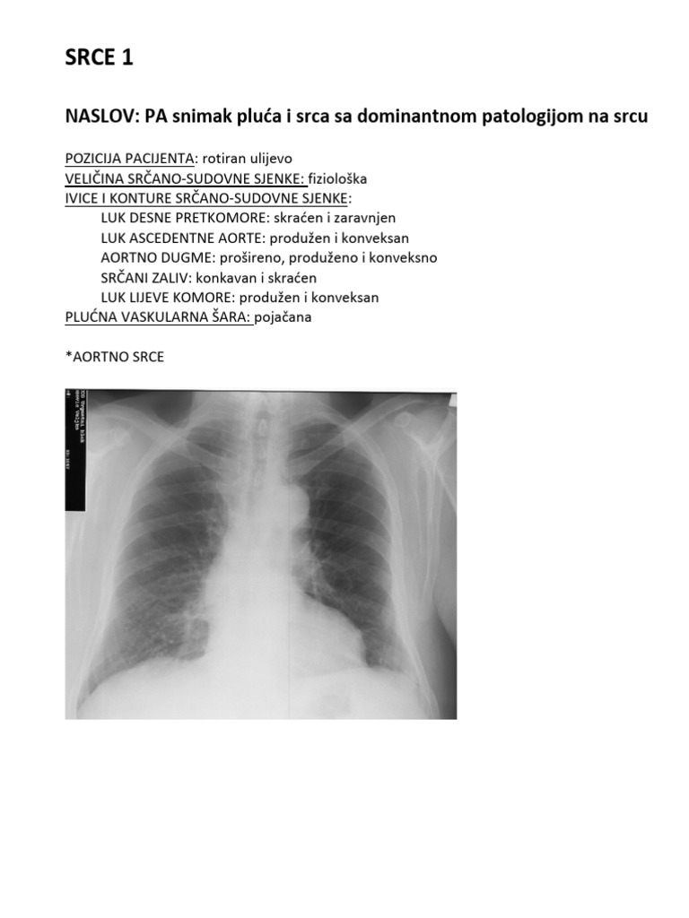Srce 1: NASLOV: PA Snimak Pluća I Srca Sa Dominantnom Patologijom Na Srcu | PDF