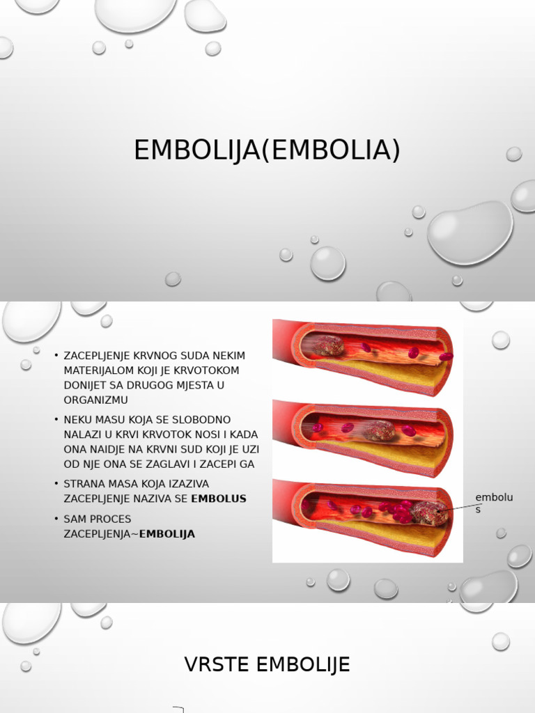 Embolija (Embolia) | PDF