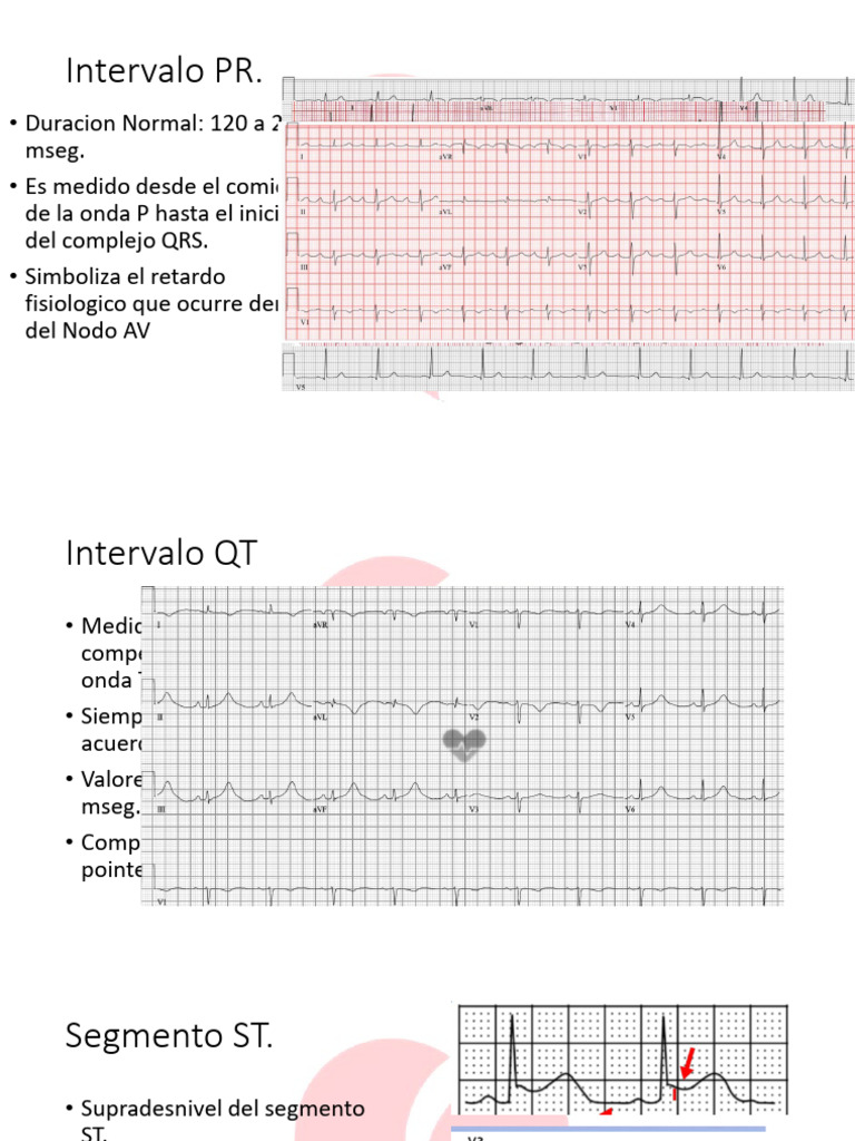 ECG y RX Torax | PDF