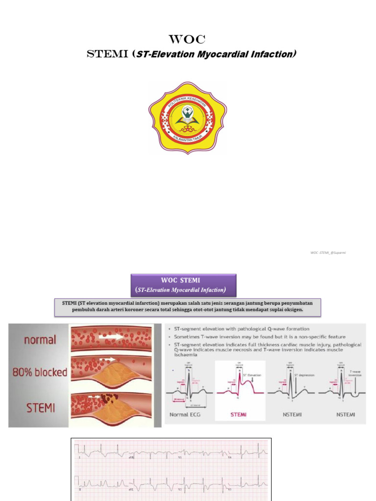 WOC-STEMI_Suparmi-1 | PDF